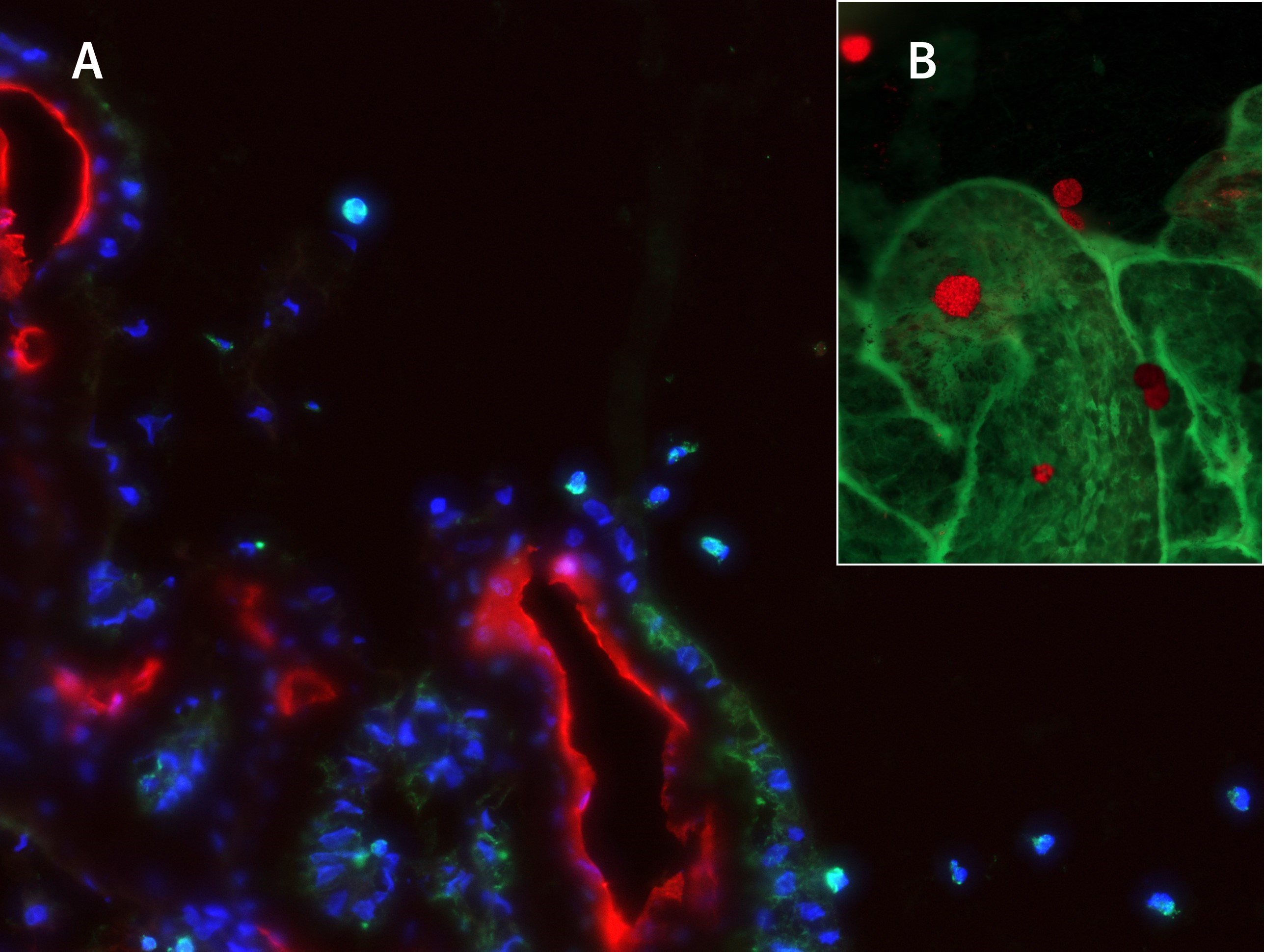 Role of Immune Cells in Early Diabetic Cataract Development | HAWK ...